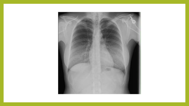 Approach to cxr | PPTX | Lung and Respiratory Health | Diseases and ...