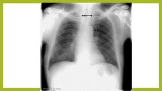 Approach to cxr | PPTX