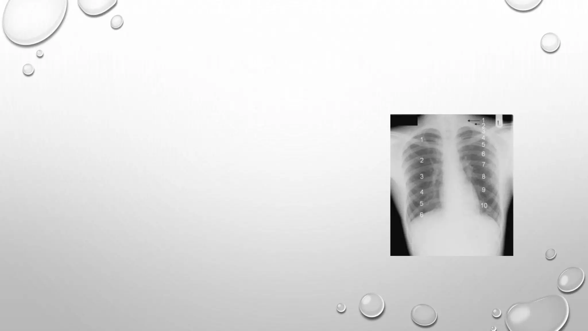 Approach to cxr.pptx