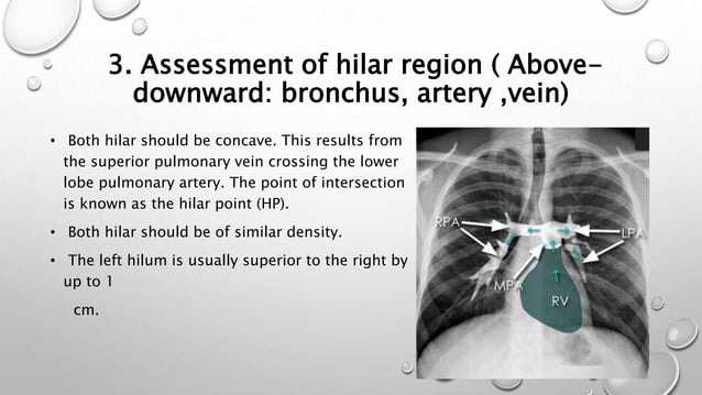 Approach to cxr.pptx