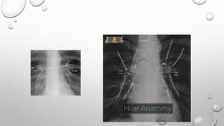 Approach to cxr.pptx
