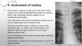 Approach to cxr.pptx