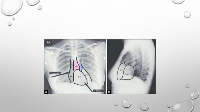 Approach to cxr.pptx