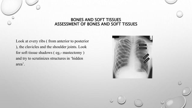 Approach to cxr.pptx