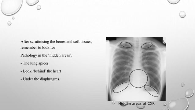Approach to cxr.pptx