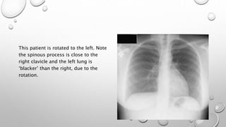 Approach to cxr.pptx