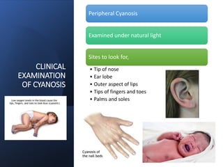 Approach to Cyanosis [Paediatrics presentation for medical (MBBS ...