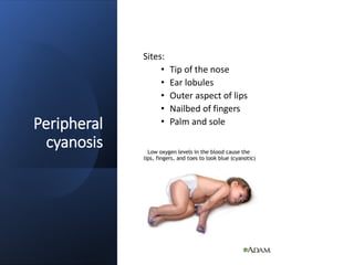 Approach to Cyanosis [Paediatrics presentation for medical (MBBS ...