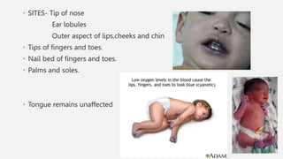 APPROACH TO CYANOSIS .pptx