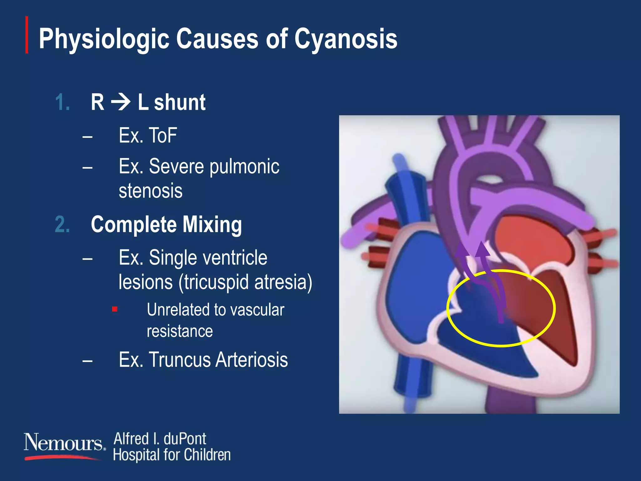 Approach to cyanotic chd | PPTX