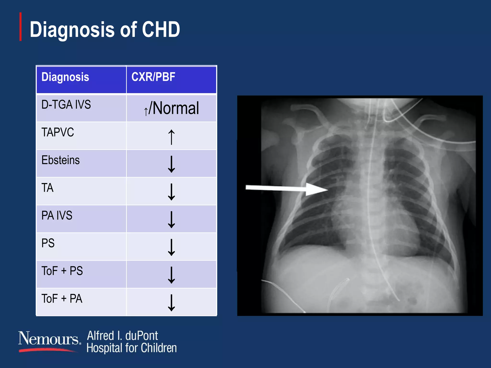 Approach to cyanotic chd | PPTX