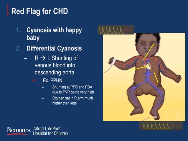Approach to cyanotic chd | PPTX