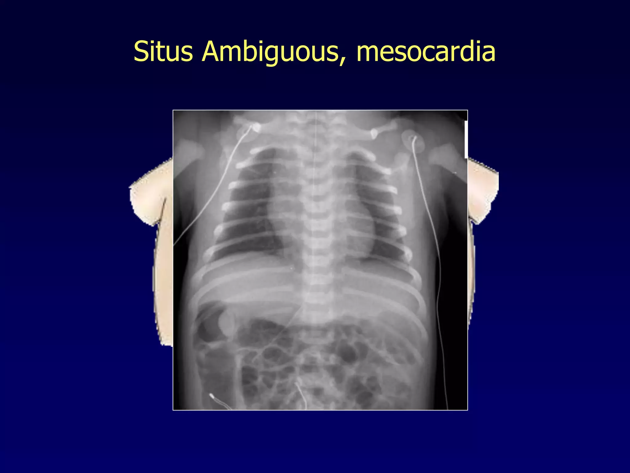 Approach to cyanotic congenital heart disease | PPTX