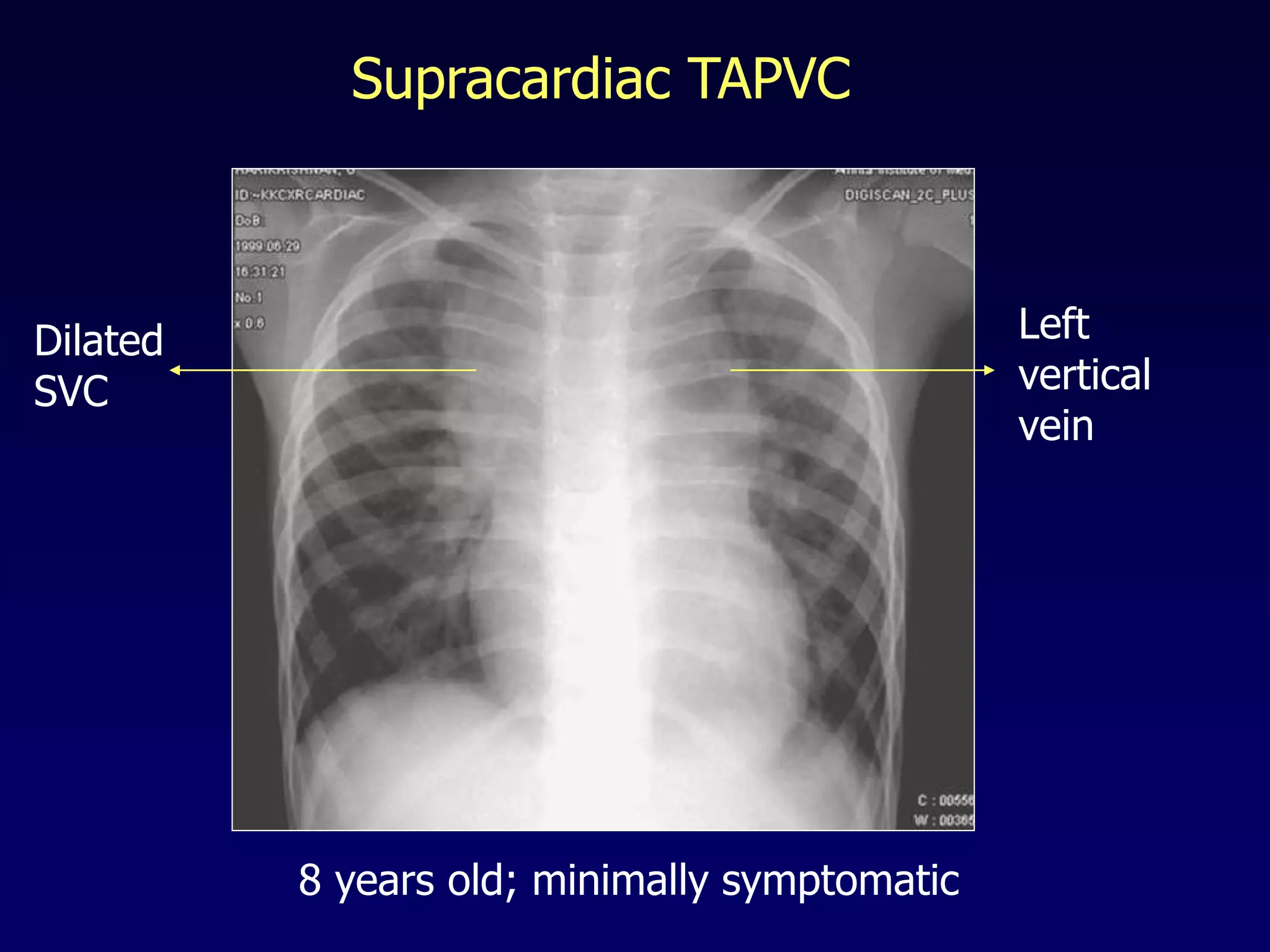 Approach to cyanotic congenital heart disease | PPTX