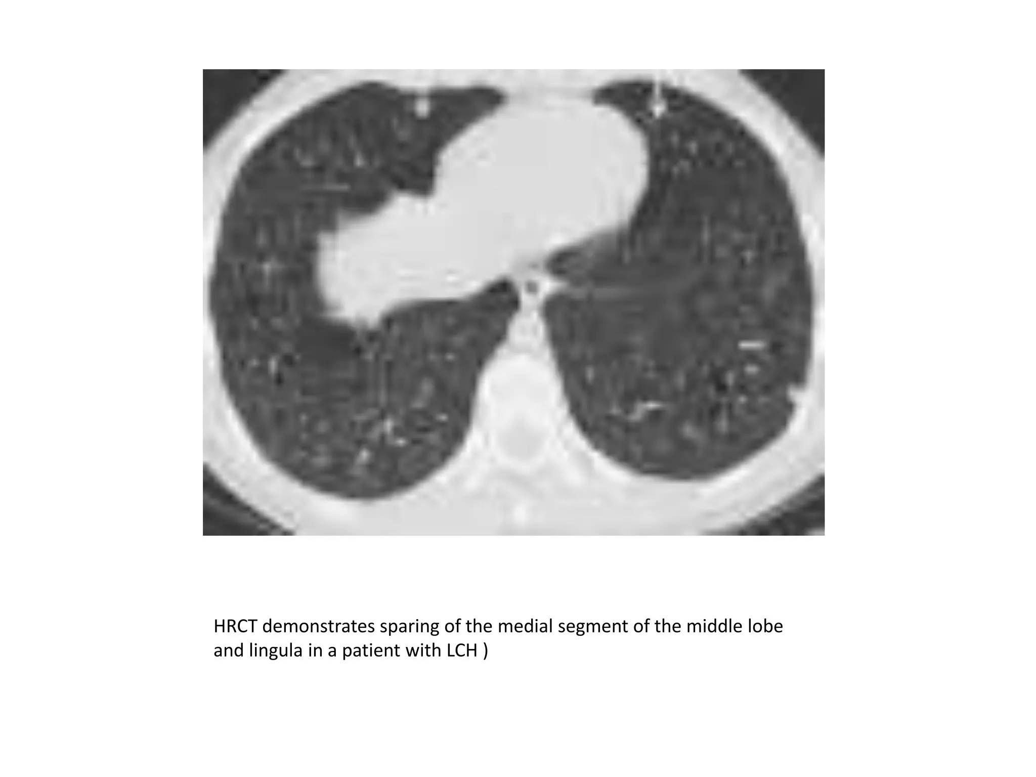 Approach to cystic lung disease on hrct | PPTX