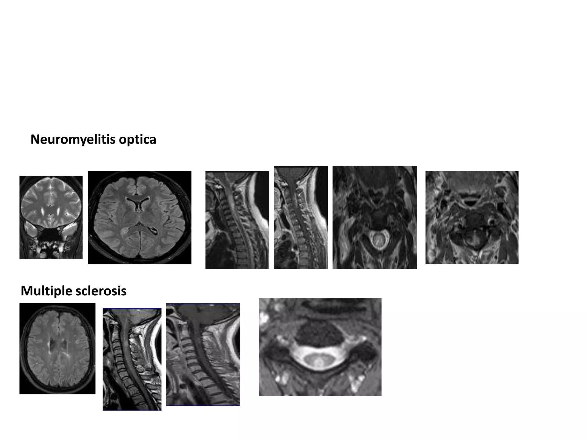 Approach to demyelinating diseases | PPTX