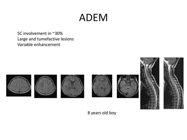 Approach to demyelinating diseases | PPTX