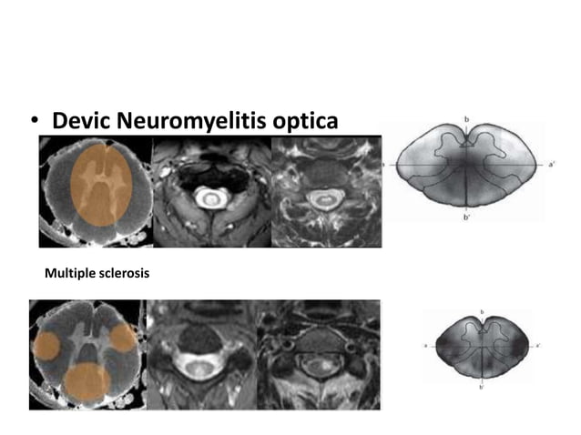 Approach to demyelinating diseases | PPTX