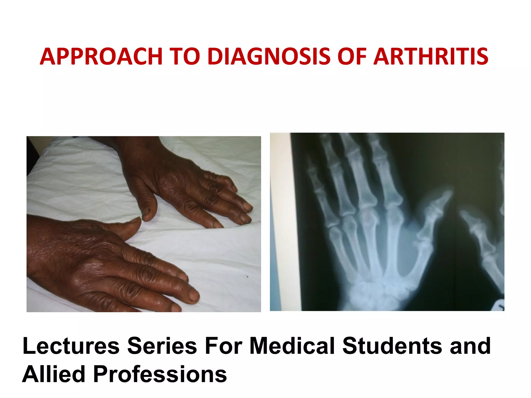 Approach to diagnosis of arthritis | PPT