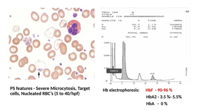 Approach to diagnosis of hemolytic anemia.pptx