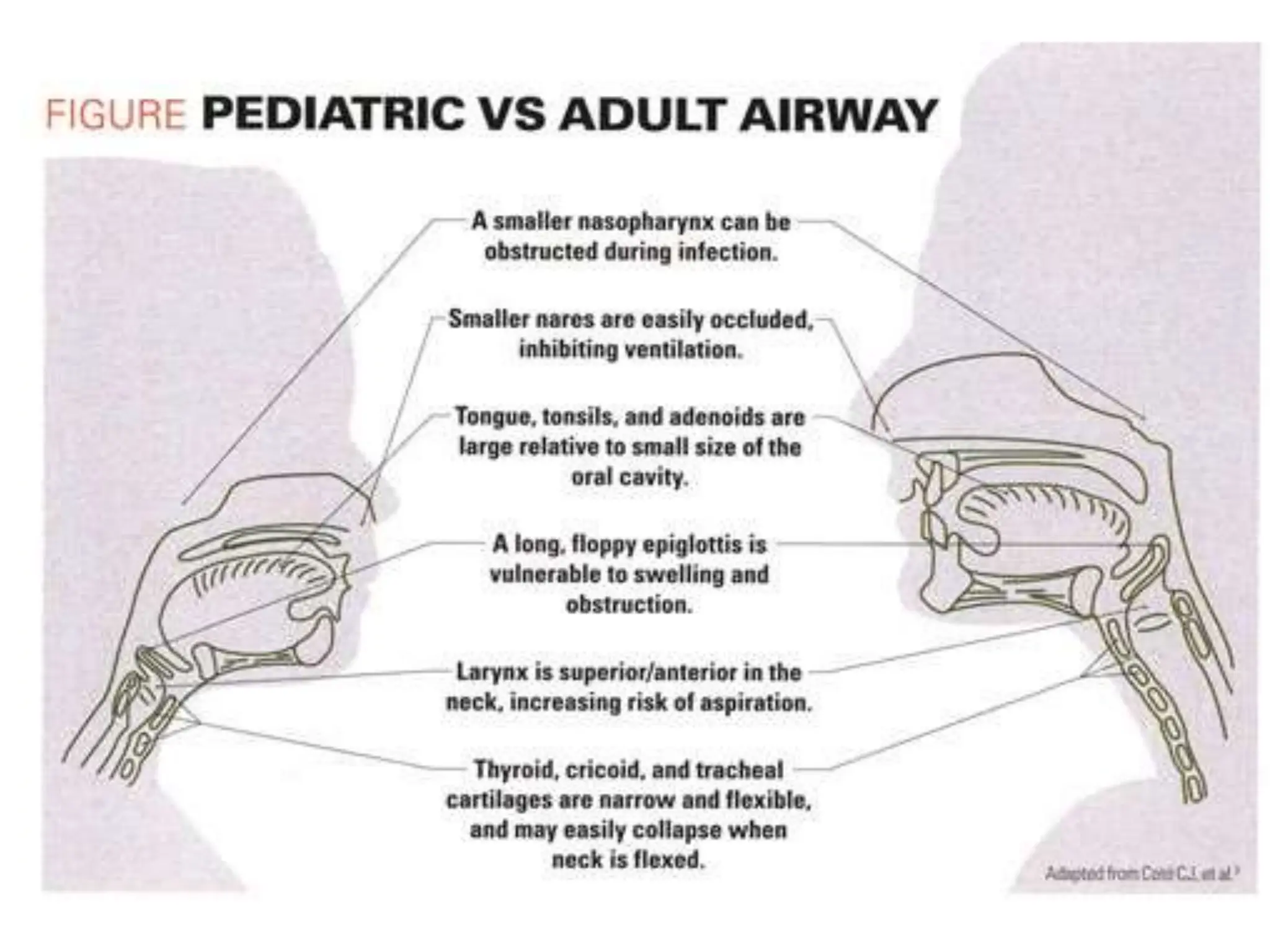 Approach to Difficult and Compromised Airway in Neonatal.pptx