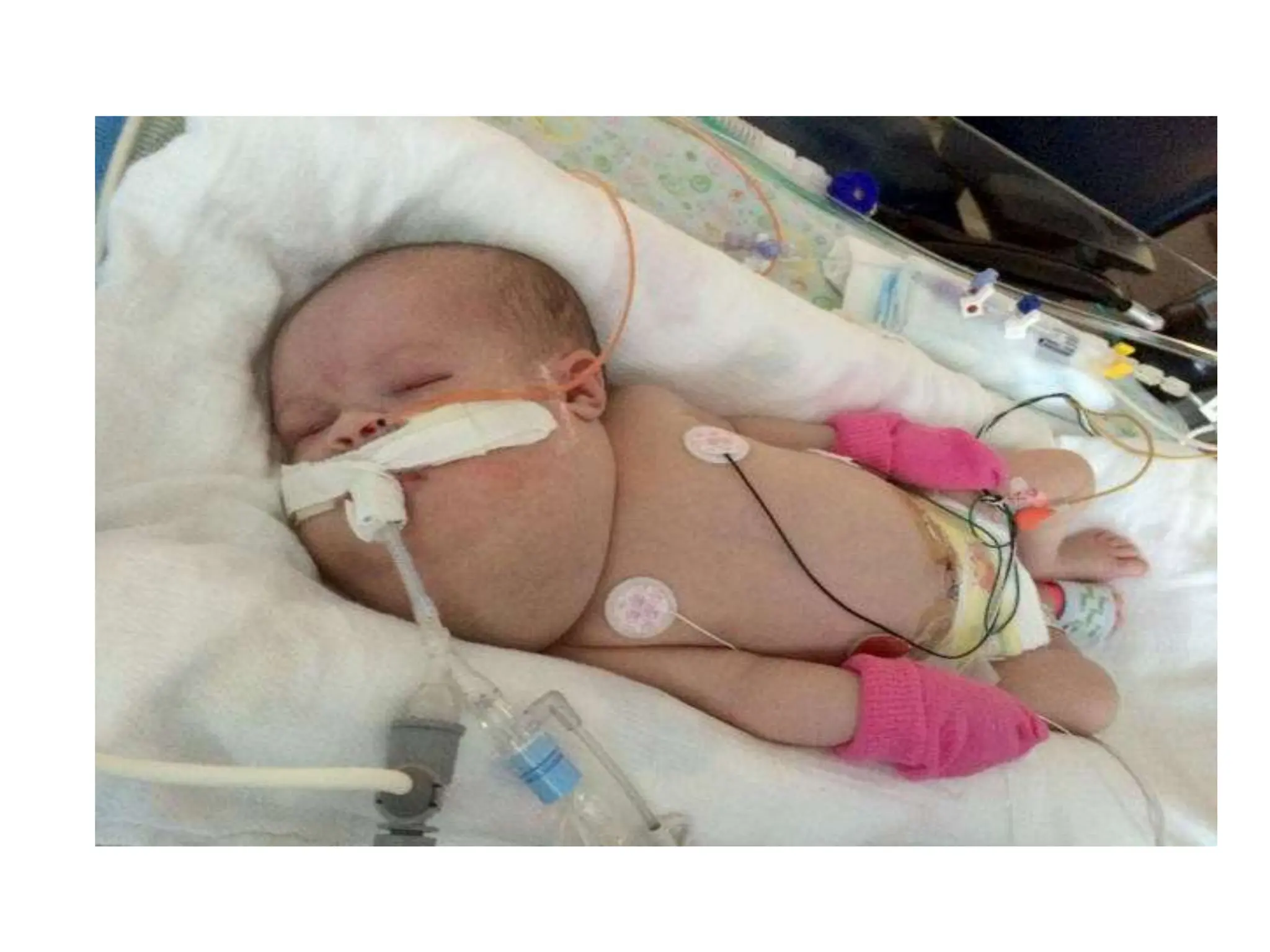 Approach to Difficult and Compromised Airway in Neonatal.pptx