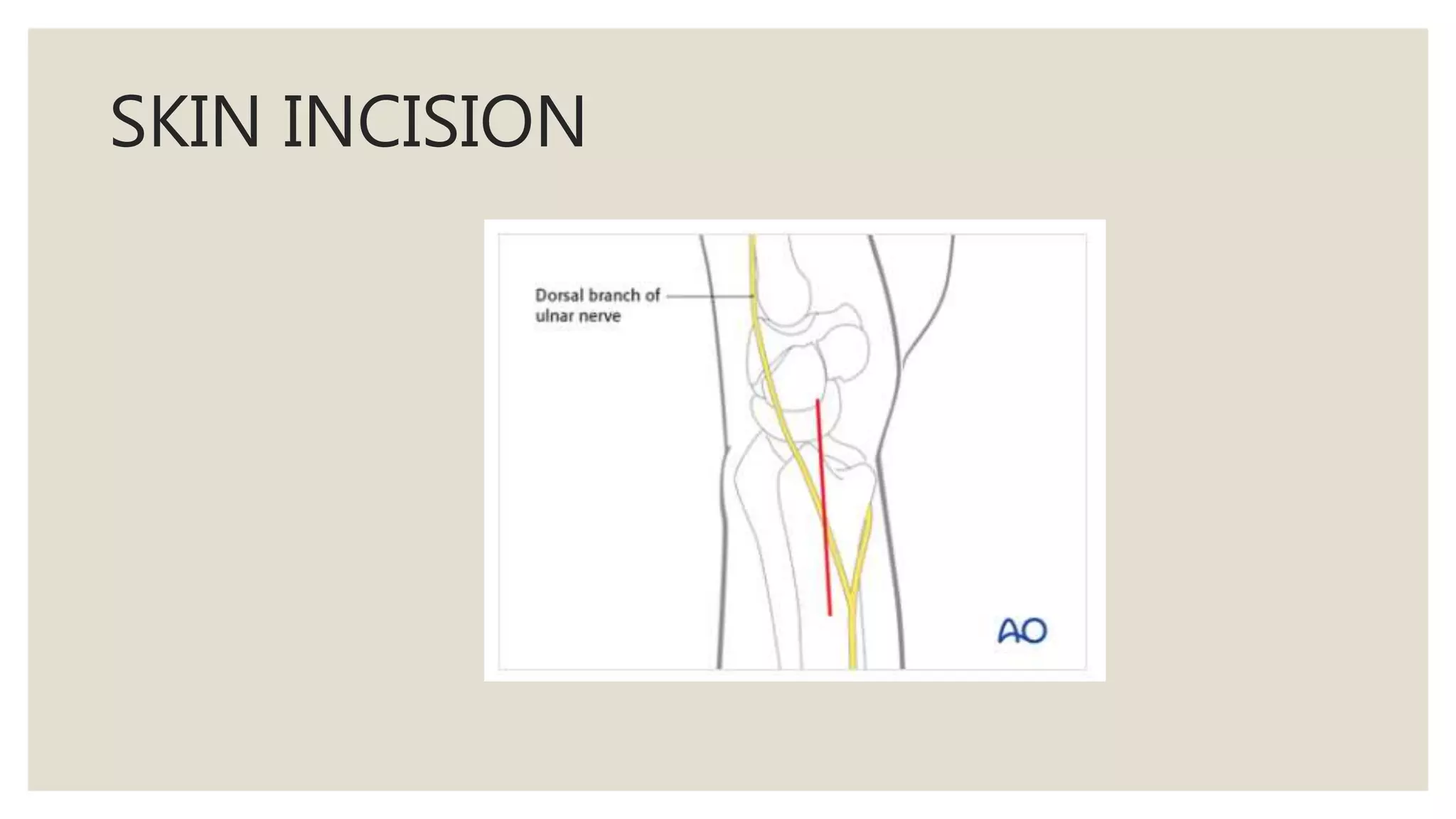 Approach To Distal Ulnapptx