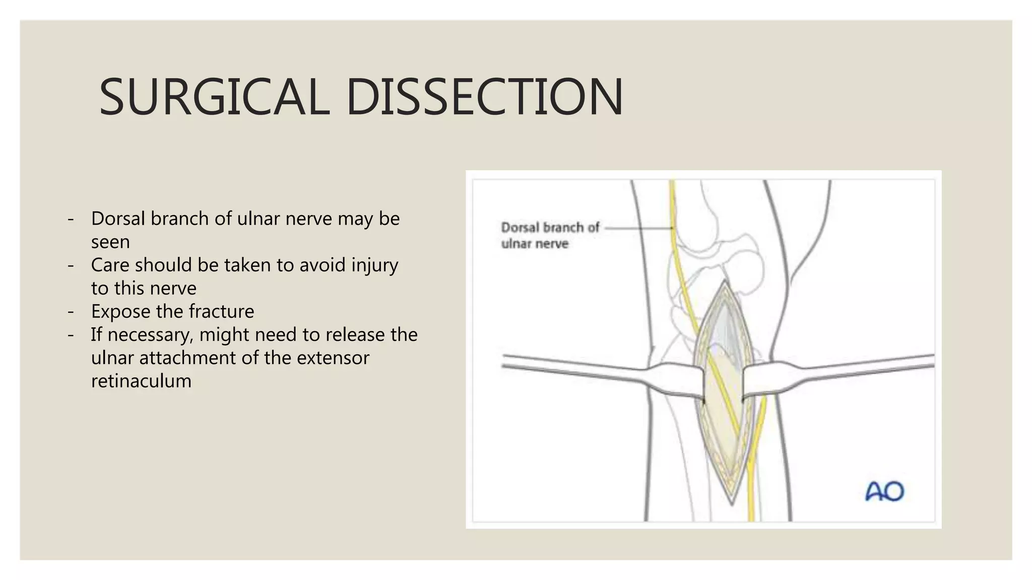 Approach to distal ulna.pptx