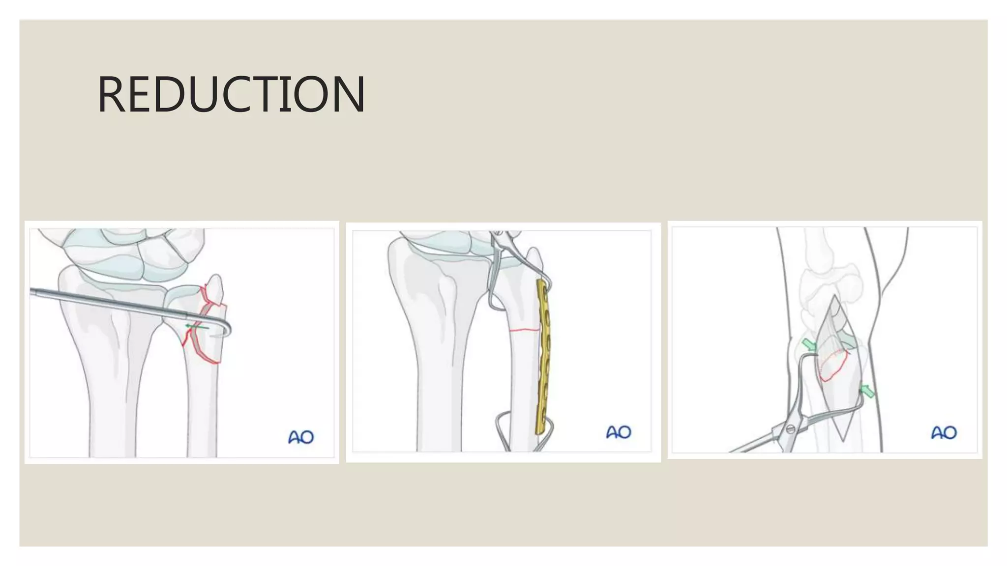 Approach To Distal Ulnapptx