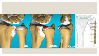 Approach to distal ulna.pptx