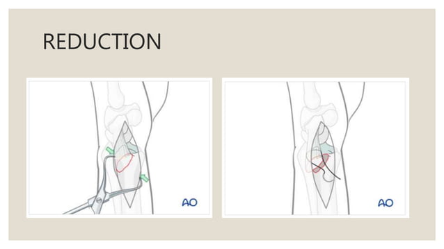 Approach To Distal Ulnapptx