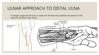 Approach to distal ulna.pptx