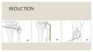 Approach to distal ulna.pptx