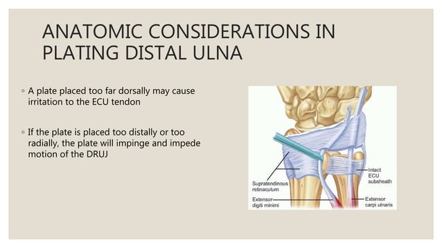 Approach to distal ulna.pptx | Death, Injury, or Military Conflict ...