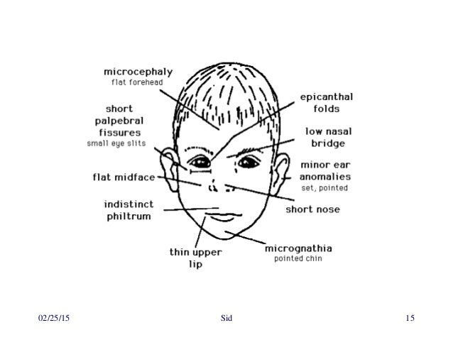 Approach to dysmorphic child