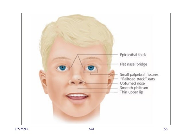 Approach to dysmorphic child
