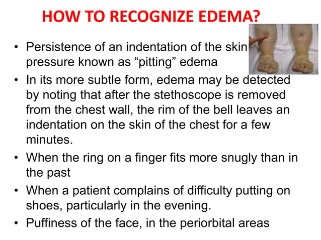 approach to edema.pptx