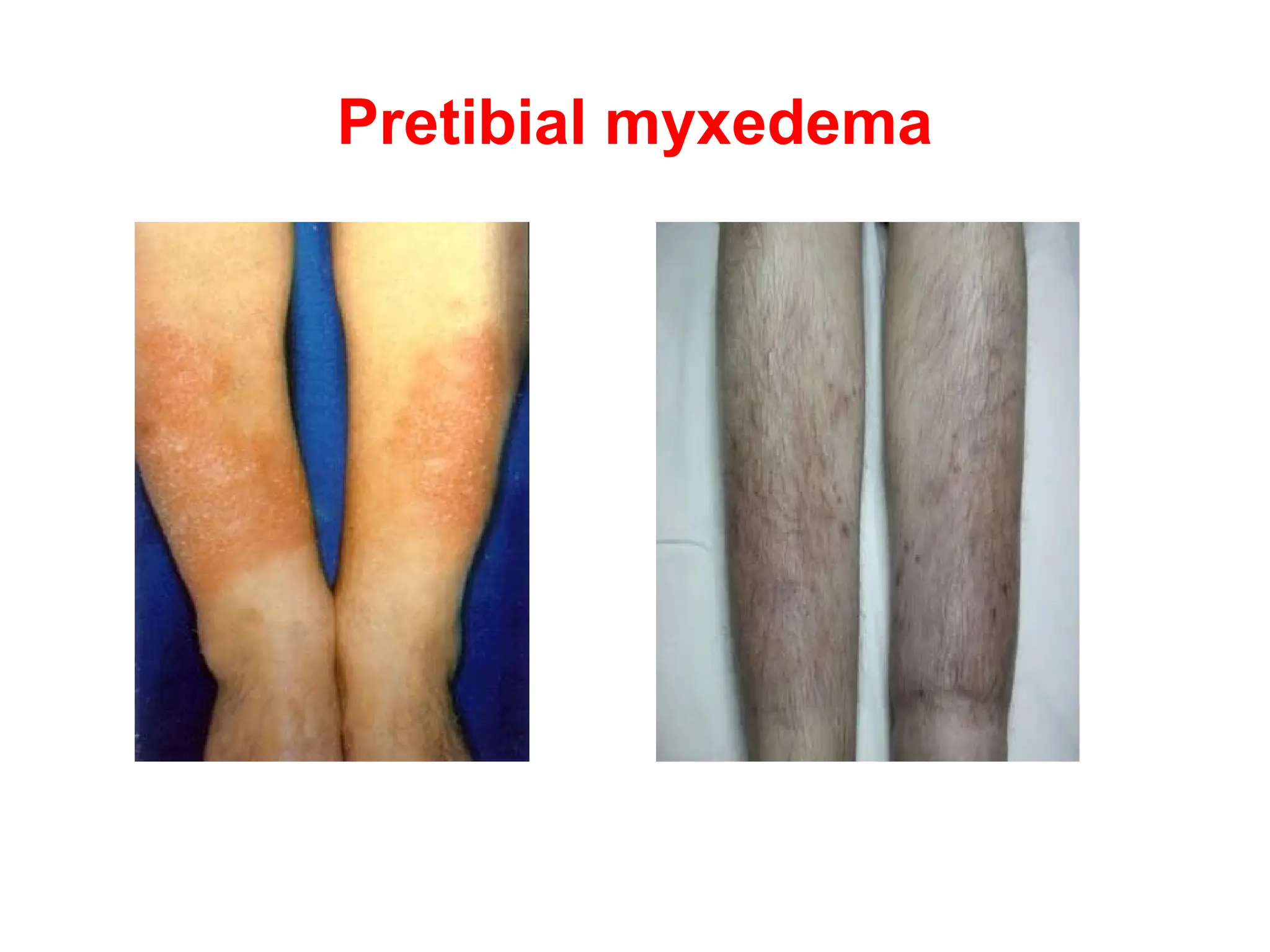 Approach to edema in clinical practice.. | PPTX