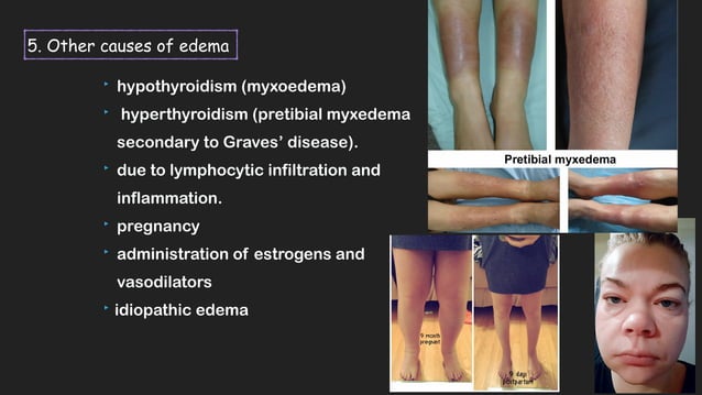 APPROACH TO EDEMA - Dr.Harishma | PDF