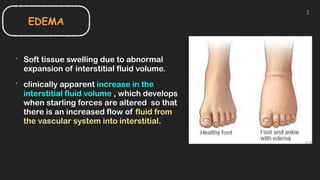 APPROACH TO EDEMA - Dr.Harishma | PDF