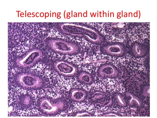 Approach to endometrial biopsy