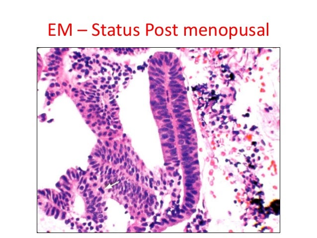 Approach to endometrial biopsy