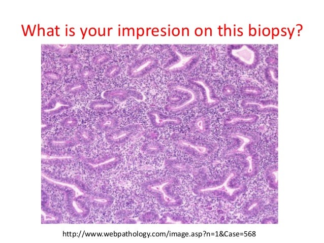 Approach to endometrial biopsy