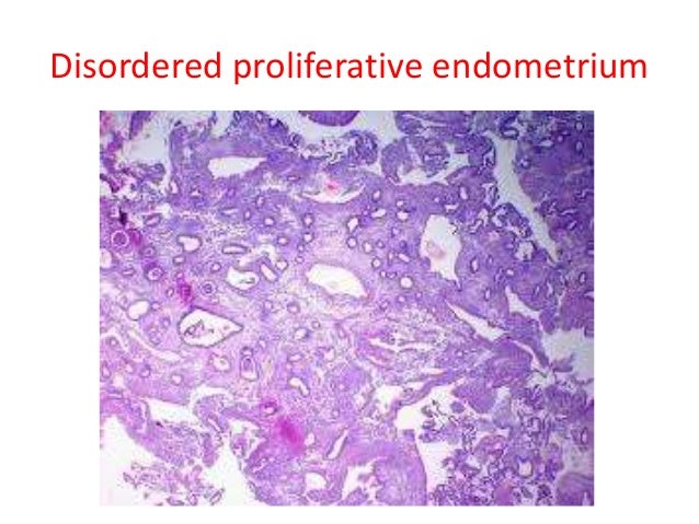 Approach to endometrial biopsy