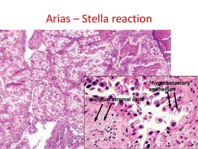 Approach to endometrial biopsy