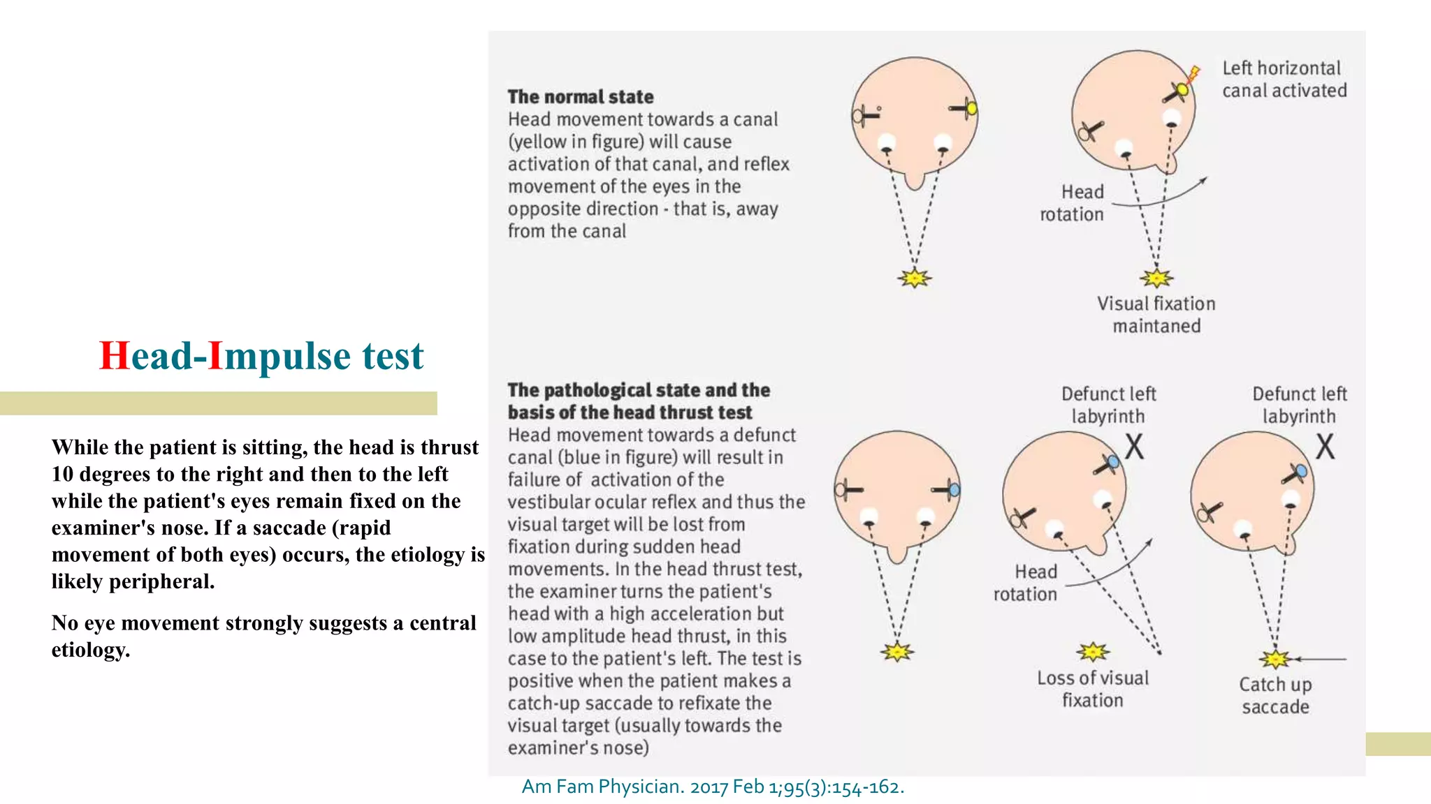 Approach to evaluation and management of acute vertigo | PPTX