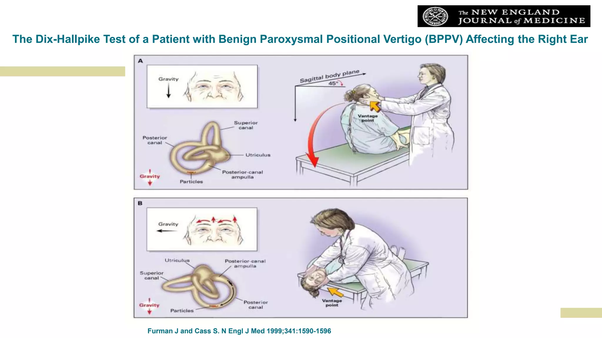 Approach to evaluation and management of acute vertigo | PPTX