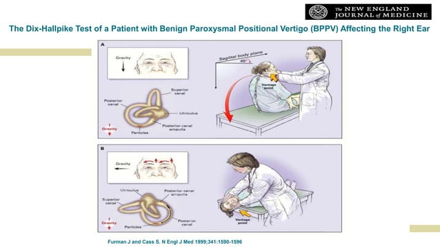 Approach to evaluation and management of acute vertigo | PPTX | Brain ...