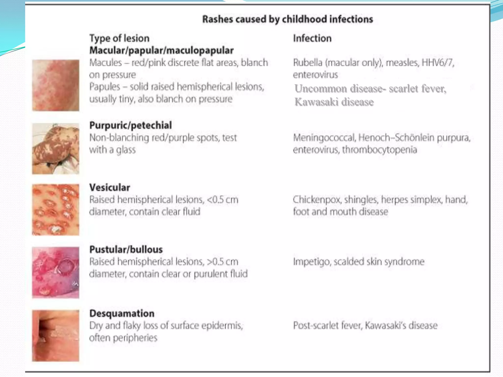 Approach to fever with rashes | PPTX