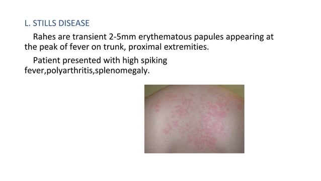 APPROACH TO FEVER WITH RASHES.pptx
